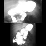 Malrotation With Midgut Volvulus | Pediatric Radiology Reference ...