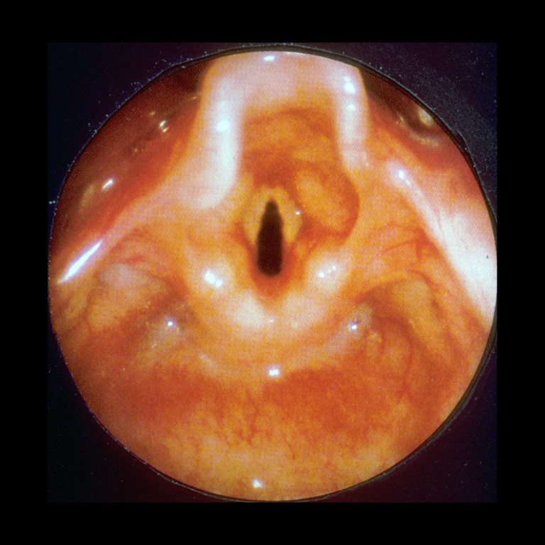 Pediatric Normal Airway | Pediatric Radiology Reference Article ...