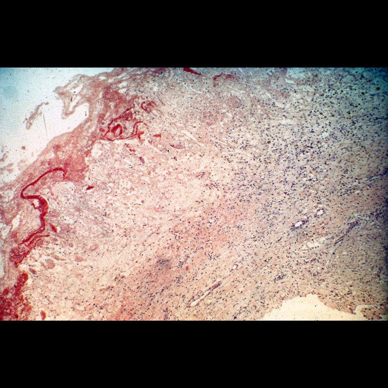 Neonatal Ovarian Cyst | Pediatric Radiology Reference Article ...