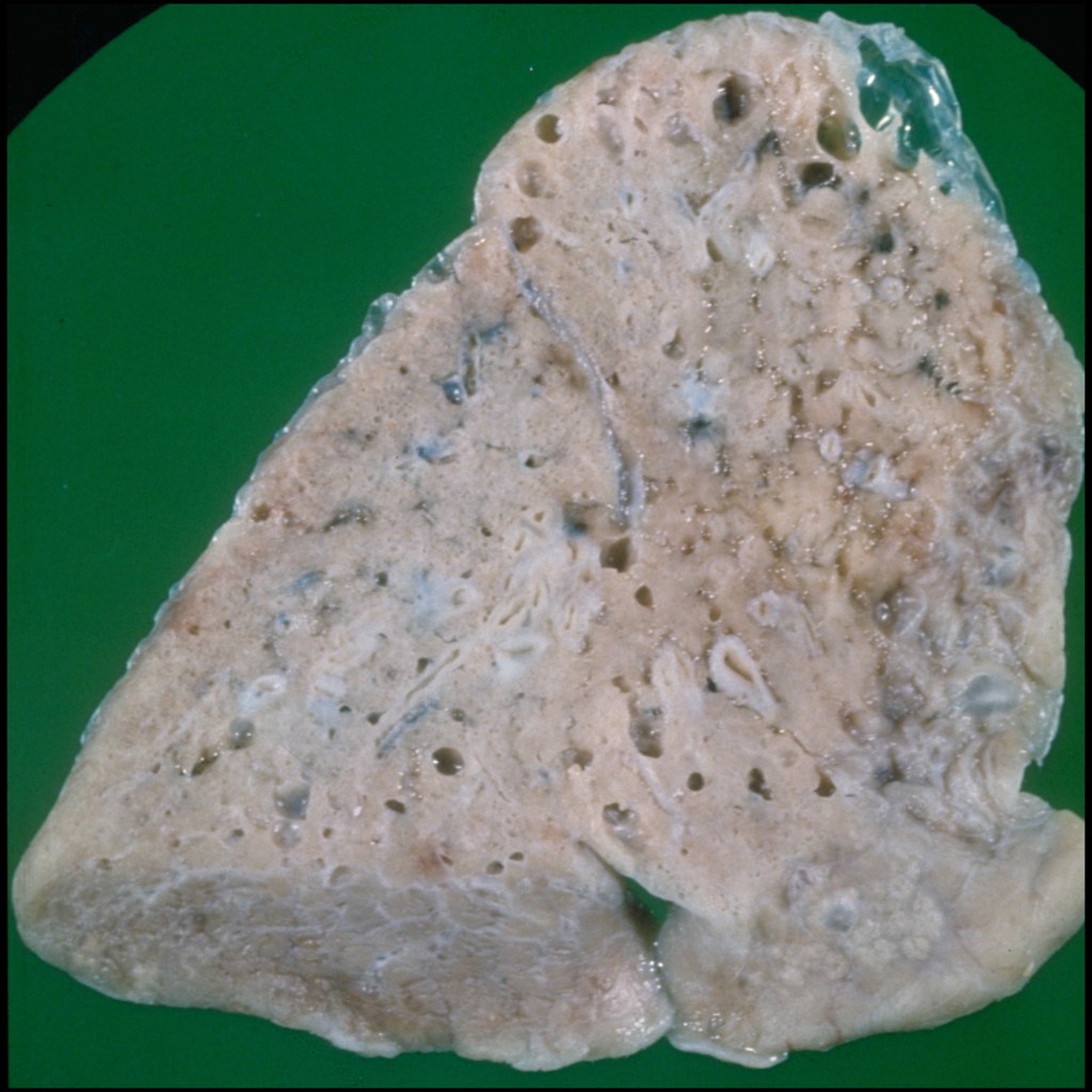 Pulmonary Interstitial Emphysema | Pediatric Radiology Reference ...