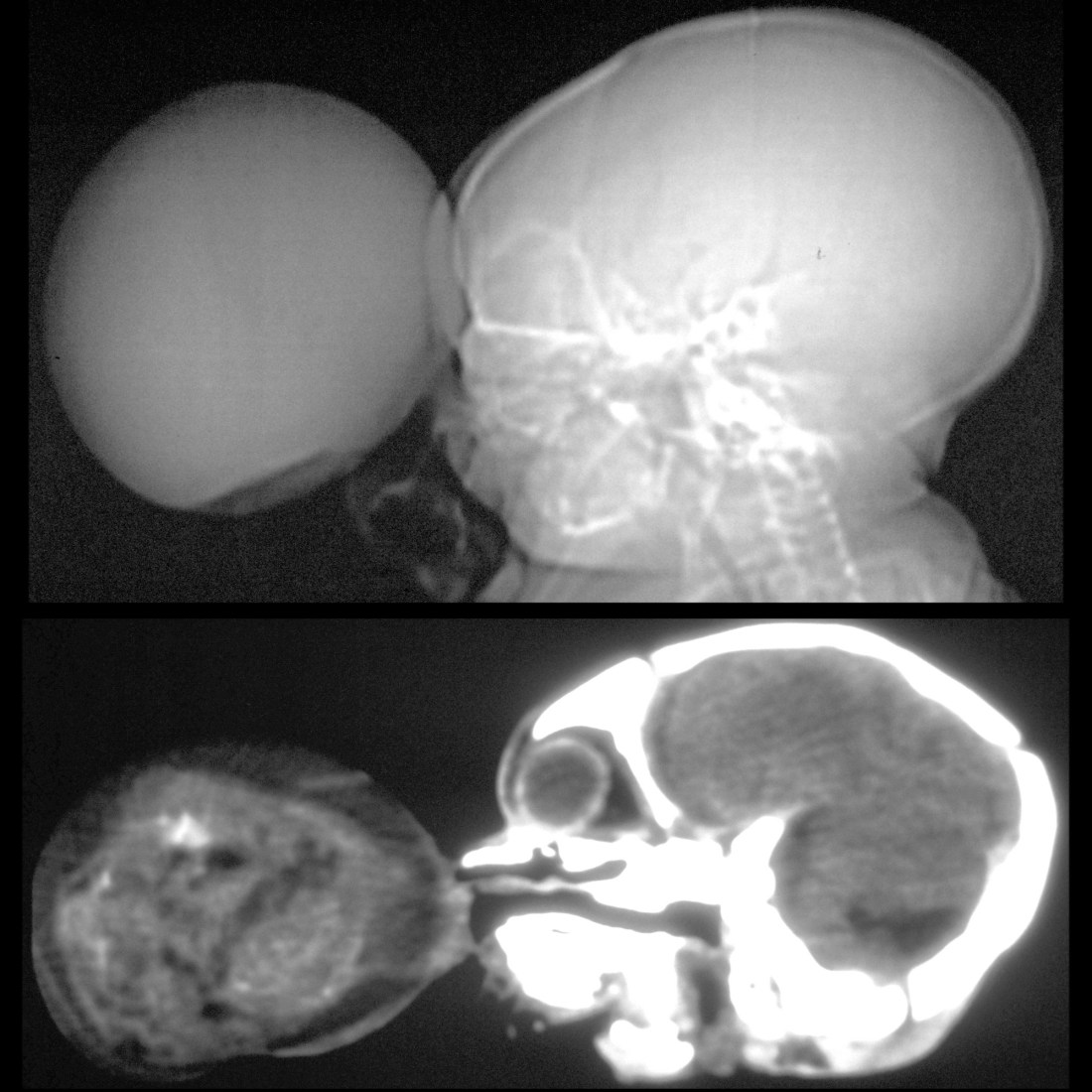 Pediatric Central Nervous System Teratoma | Pediatric Radiology ...