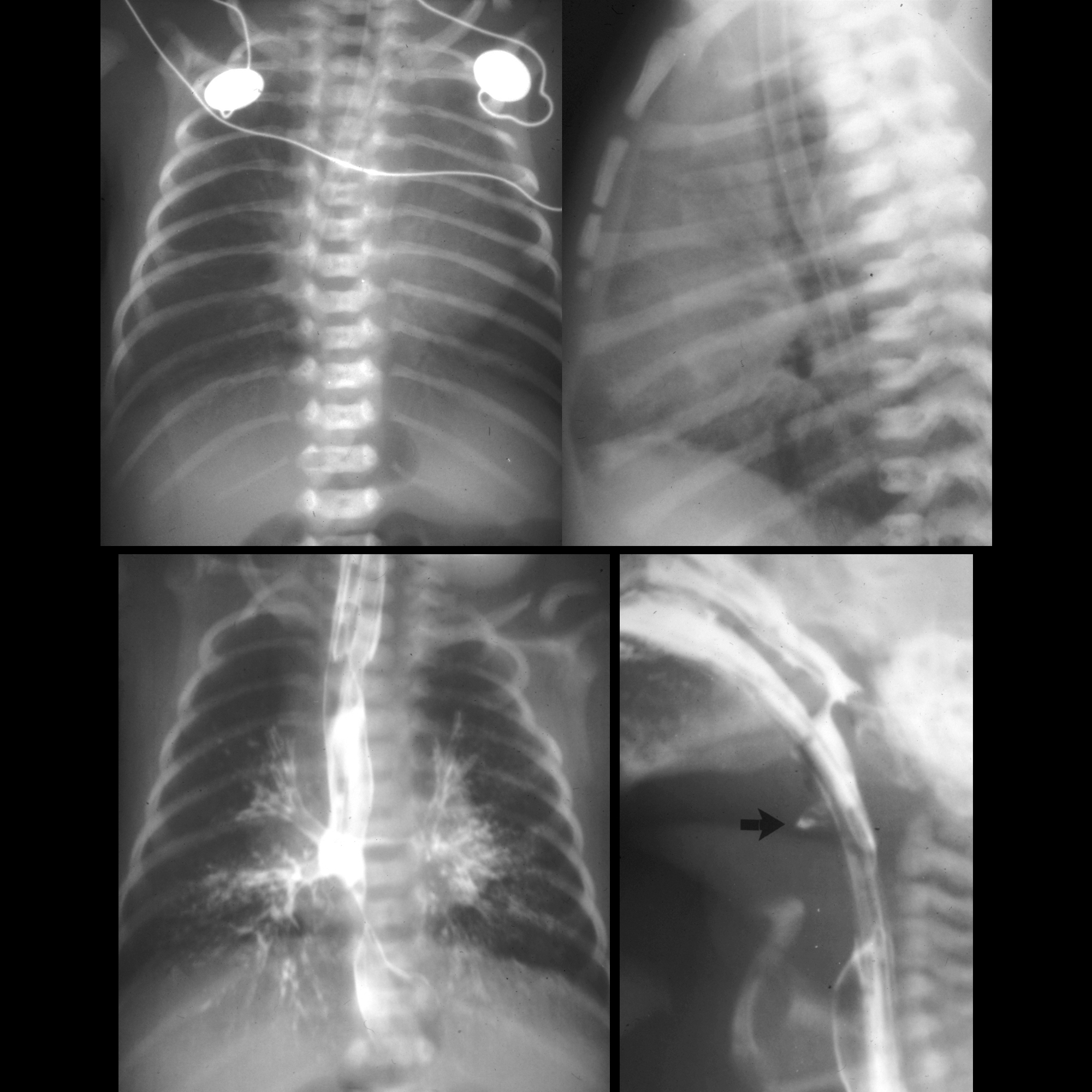 Tracheal Atresia | Pediatric Radiology Reference Article | Pediatric ...