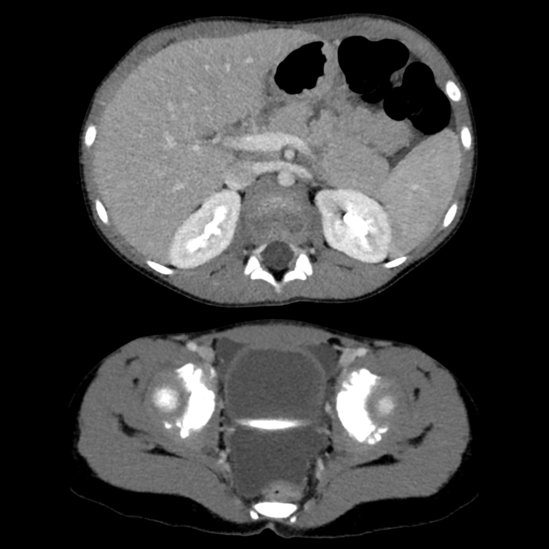 Pediatric Pancreatic Trauma | Pediatric Radiology Reference Article ...