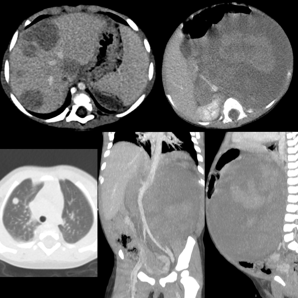 Toddler with abdominal pain and distension, hematuria and lethargy for ...
