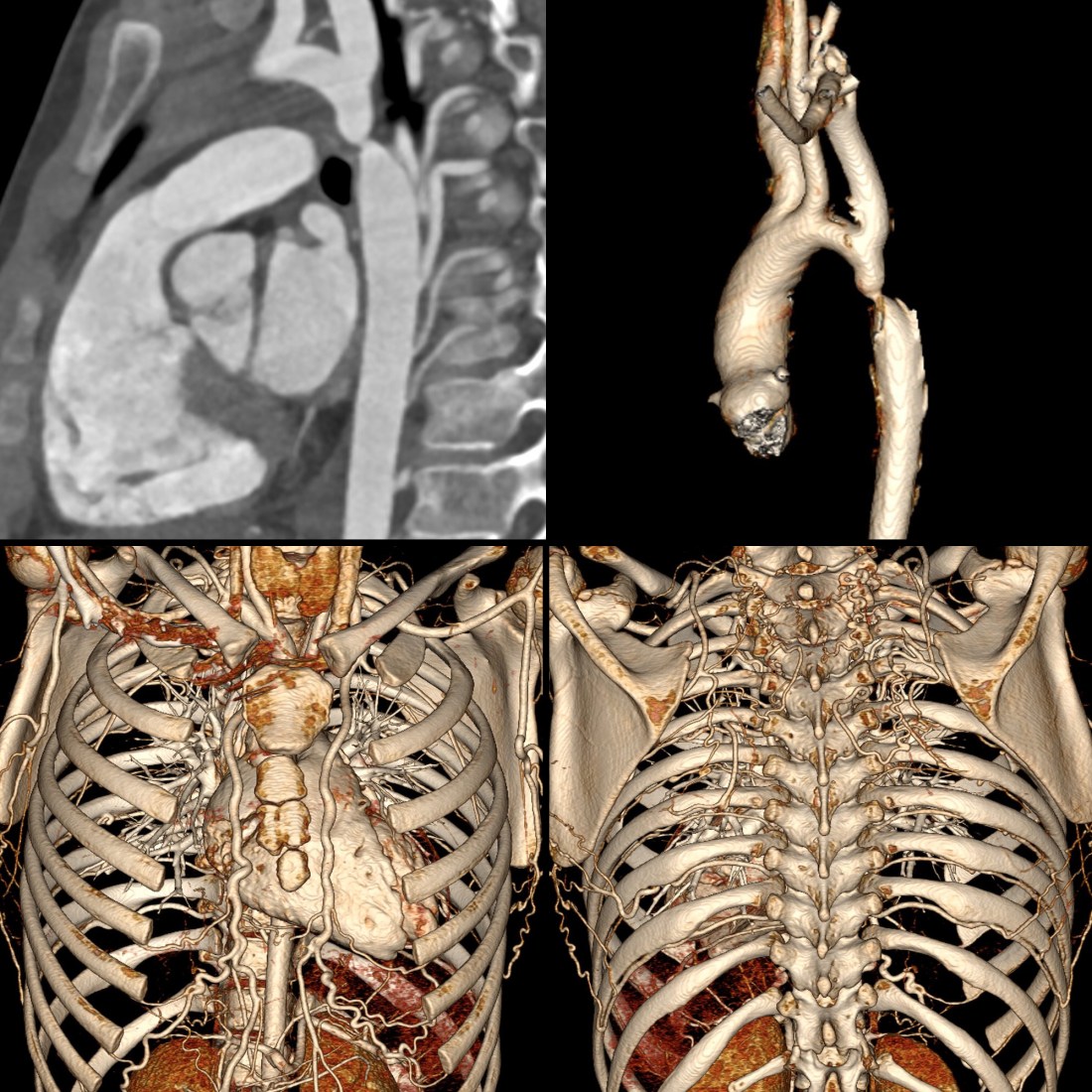 Coarctation of Aorta | Pediatric Radiology Reference Article ...