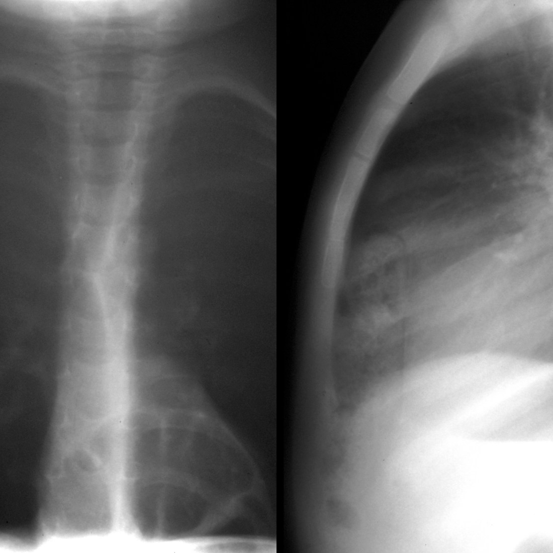 Morgagni Hernia | Pediatric Radiology Reference Article | Pediatric ...
