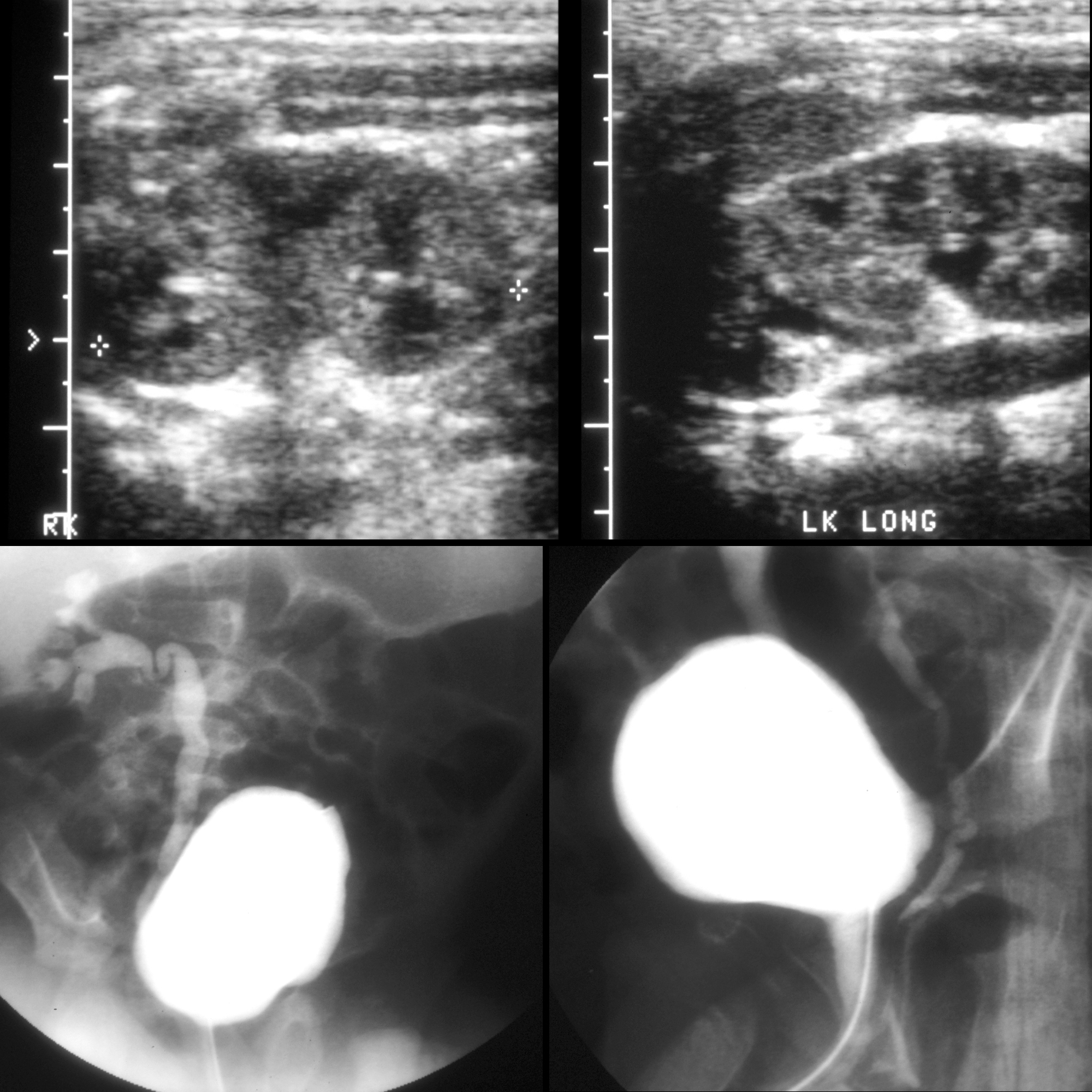 Pediatric Duplicated Kidney | Pediatric Radiology Reference Article ...