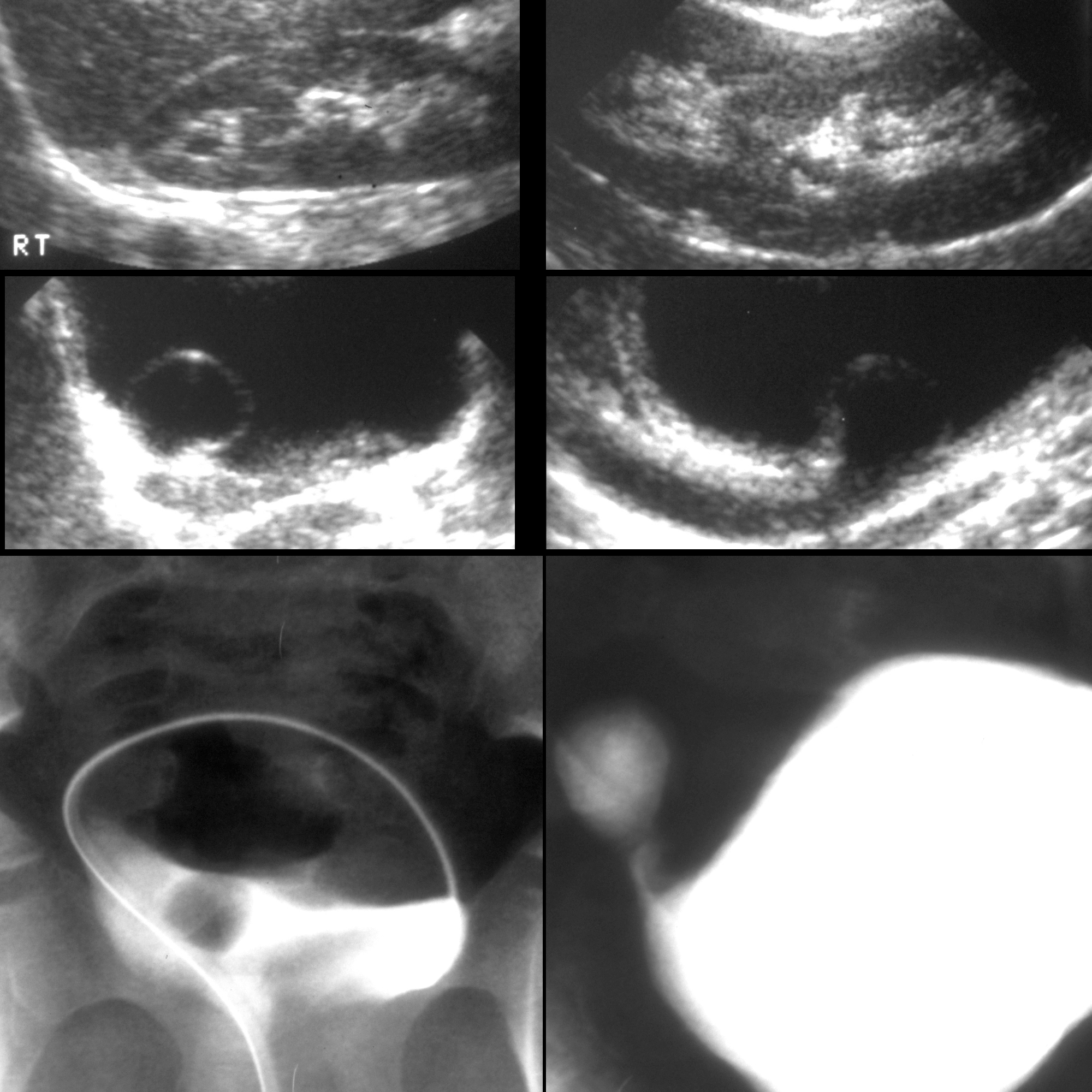 Pediatric Duplicated Kidney | Pediatric Radiology Reference Article ...