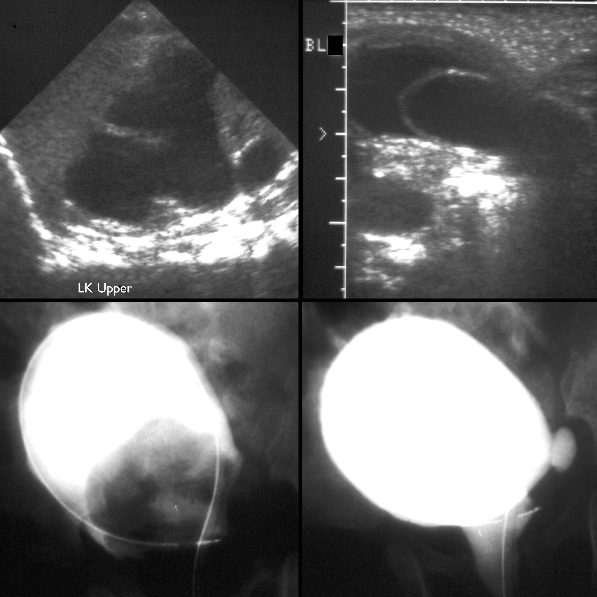 Pediatric Duplicated Kidney | Pediatric Radiology Reference Article ...