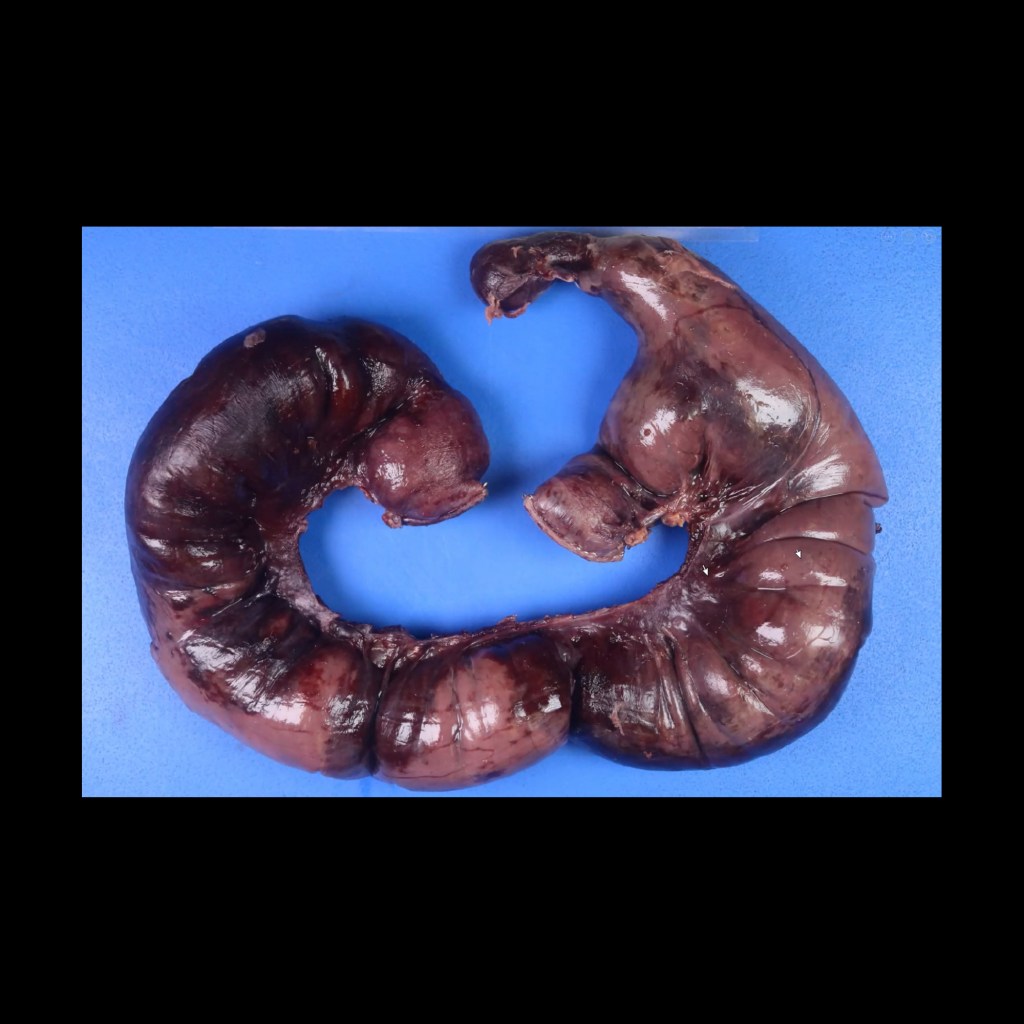 Meckel Diverticulum | Pediatric Radiology Reference Article | Pediatric ...