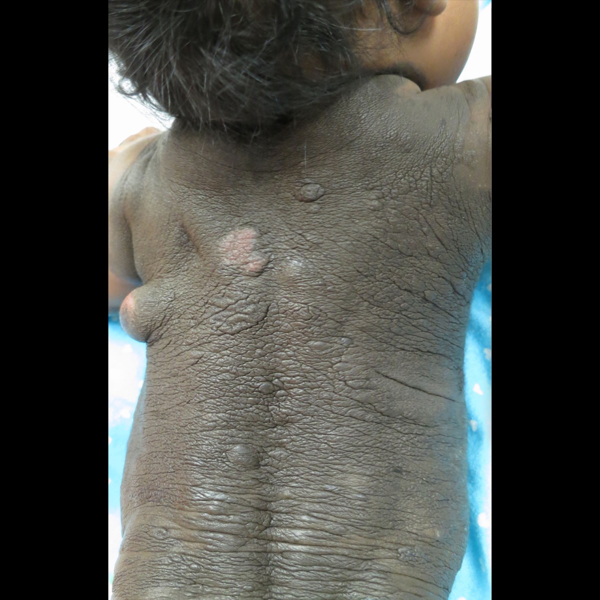 Toddler with unusual pigmentation on the back | Pediatric Radiology ...