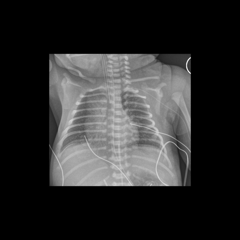 Newborn status post left upper extremity PICC placement | Pediatric ...