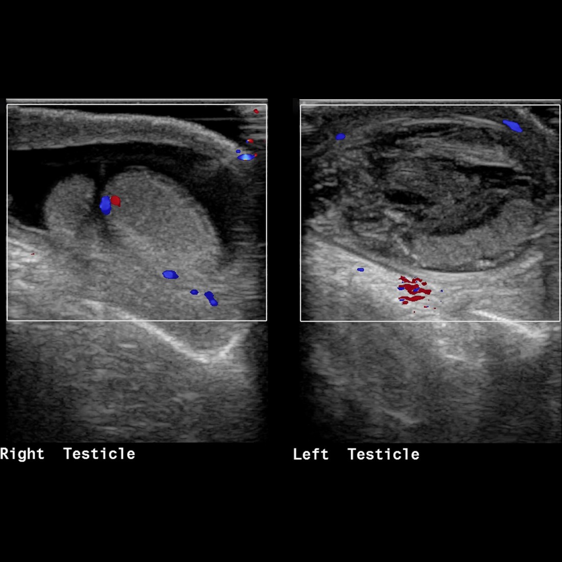 Newborn with an enlarged and firm left testis | Pediatric Radiology ...