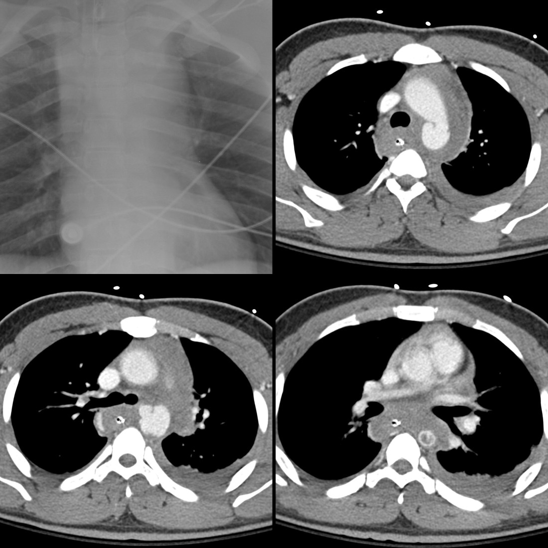 Pediatric Thoracic Aortic Injury | Pediatric Radiology Reference ...