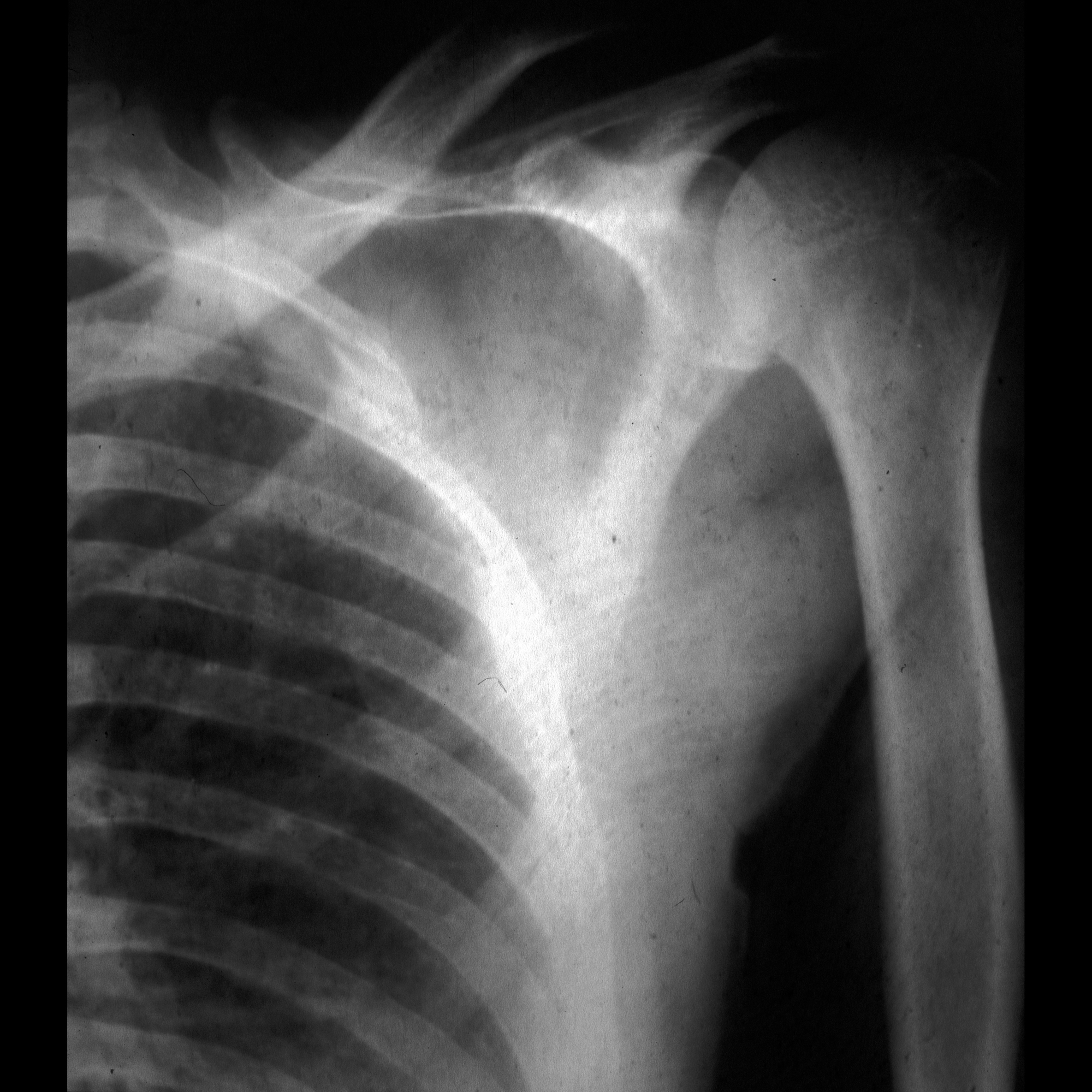 Pediatric Thoracic Aortic Injury | Pediatric Radiology Reference ...