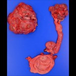 Oligohydramnios | Pediatric Radiology Reference Article | Pediatric ...