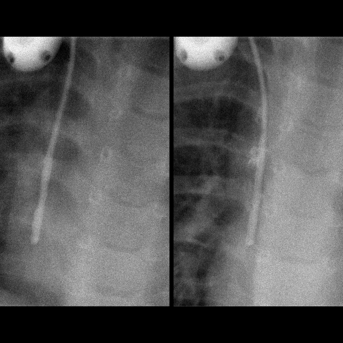 Preschooler with a central venous catheter that infuses but does not ...