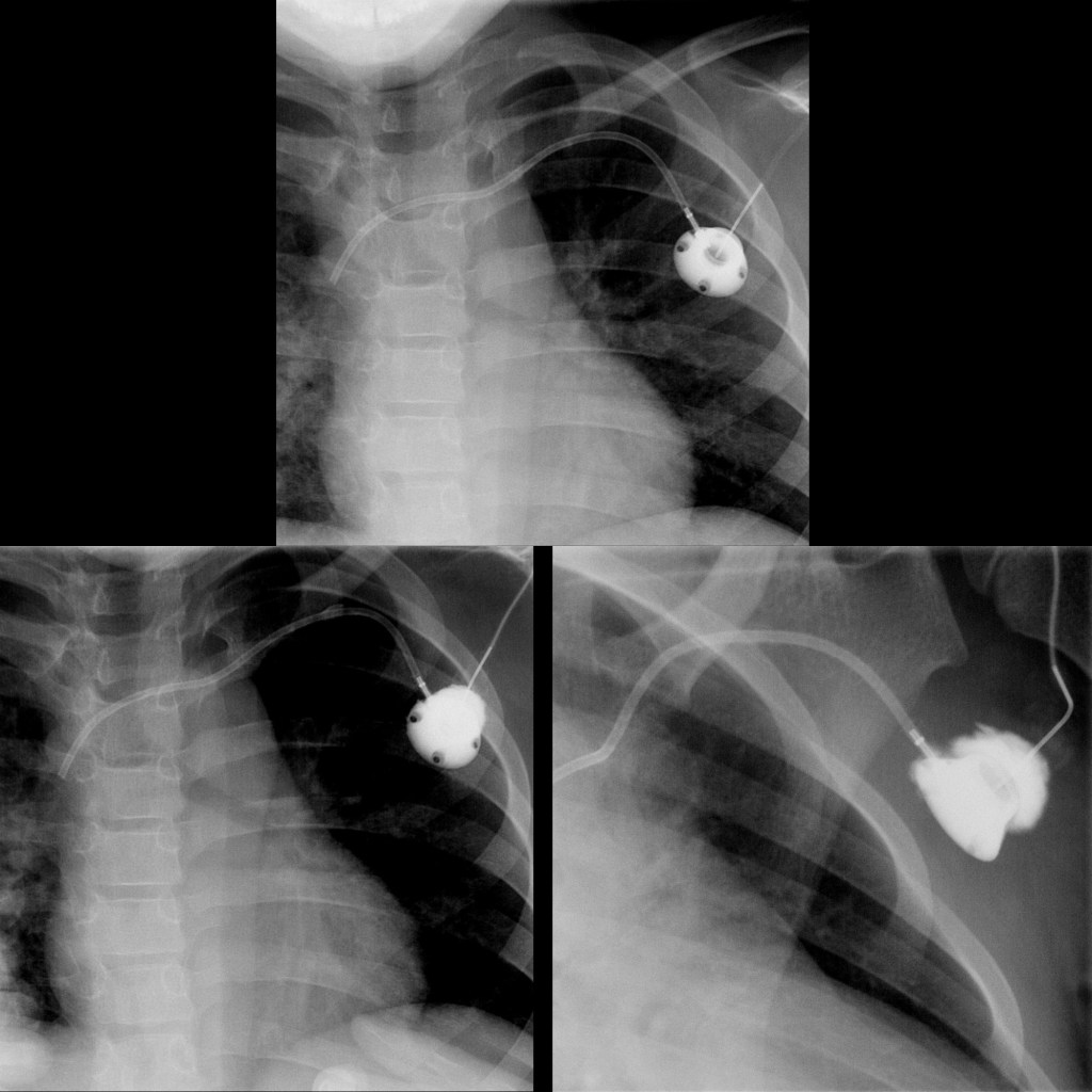 Pediatric Central Venous Catheter Malfunction / Malposition ...
