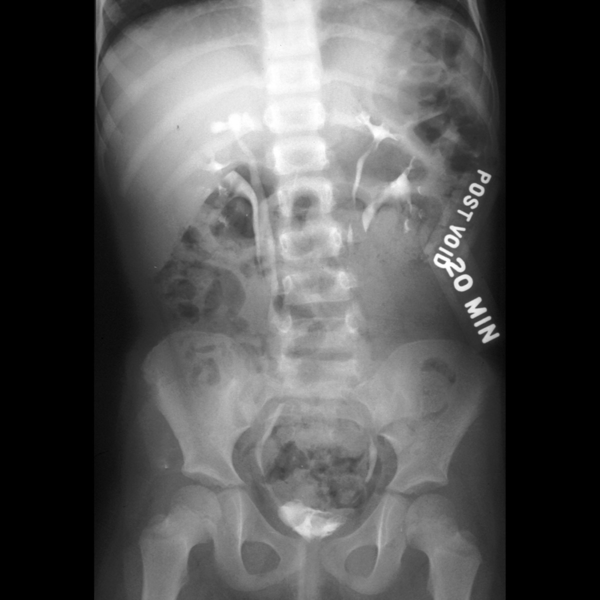 Toddler with urinary tract infection | Pediatric Radiology Case ...