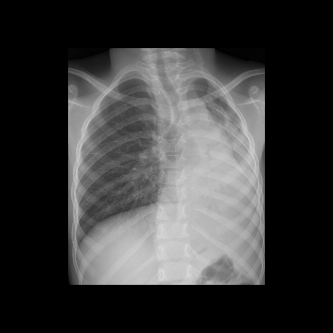 Pediatric Airway Foreign Body | Pediatric Radiology Reference Article ...