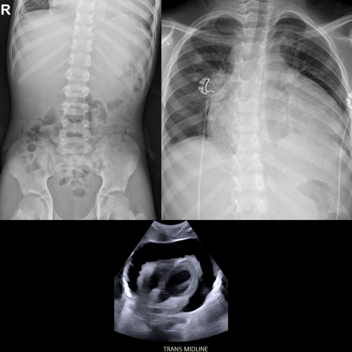 School ager with 1 week of abdominal pain and shortness of breath ...