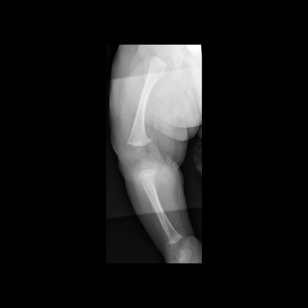 Infant who has just had a right lower extremity PICC line removed which ...