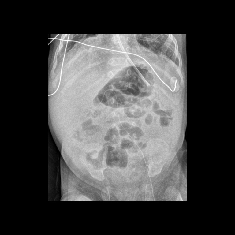 Infant who has just had a PICC line placed | Pediatric Radiology Case ...
