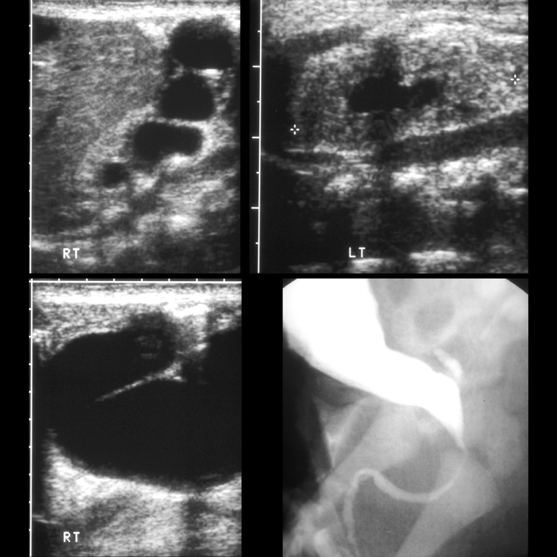 Prune Belly Syndrome | Pediatric Radiology Reference Article ...