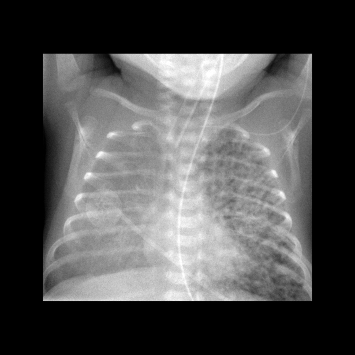Premature newborn with respiratory distress | Pediatric Radiology Case ...