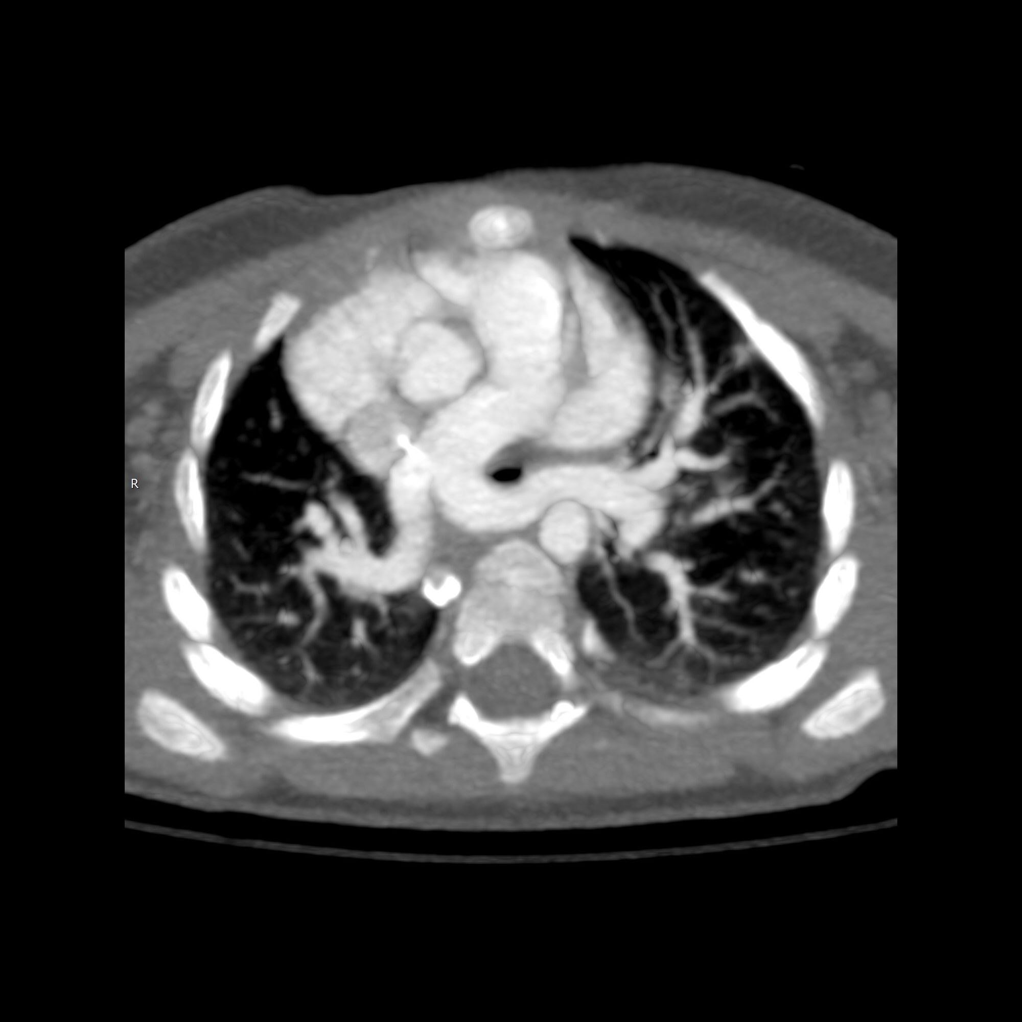 Pediatric Tracheal Stenosis | Pediatric Radiology Reference Article ...