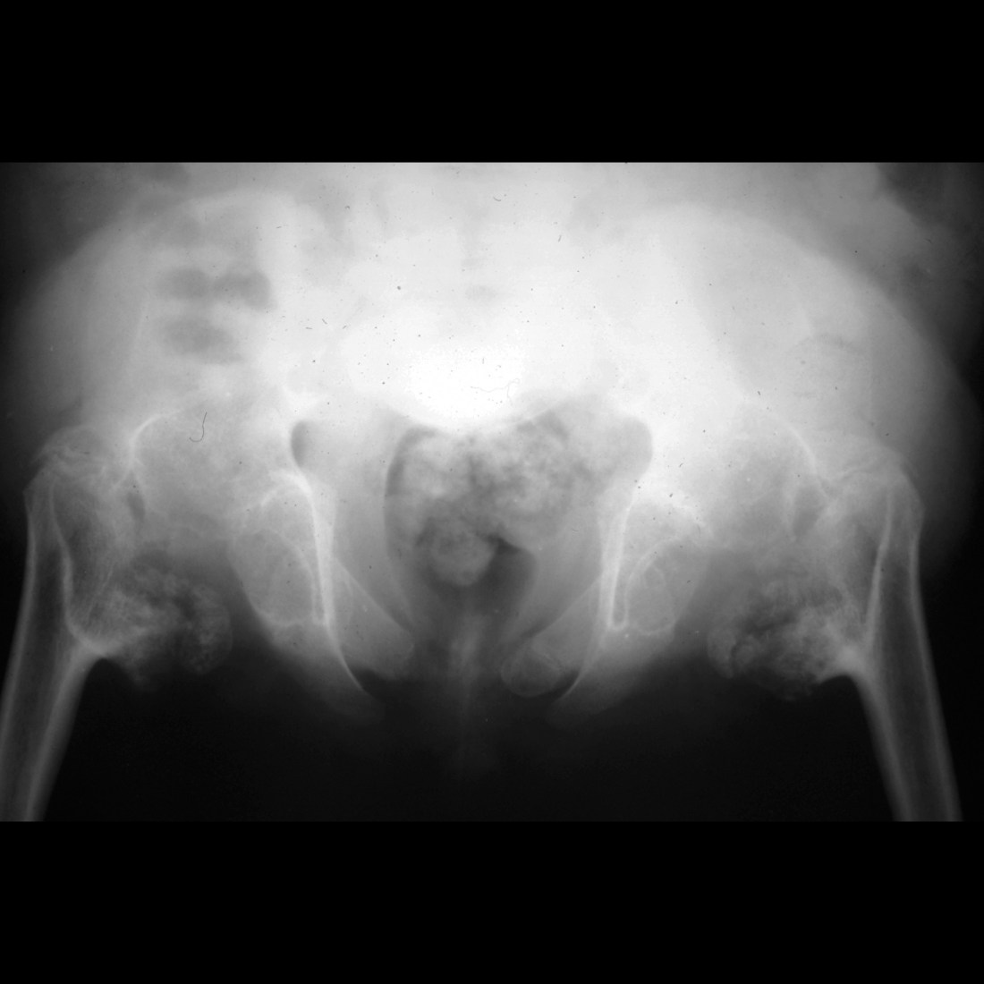 Toddler with an abnormal gait | Pediatric Radiology Case | Pediatric ...
