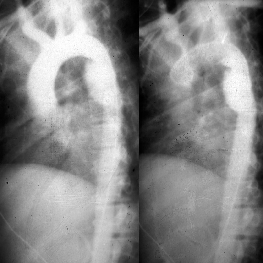 Pediatric Thoracic Aortic Injury | Pediatric Radiology Reference ...