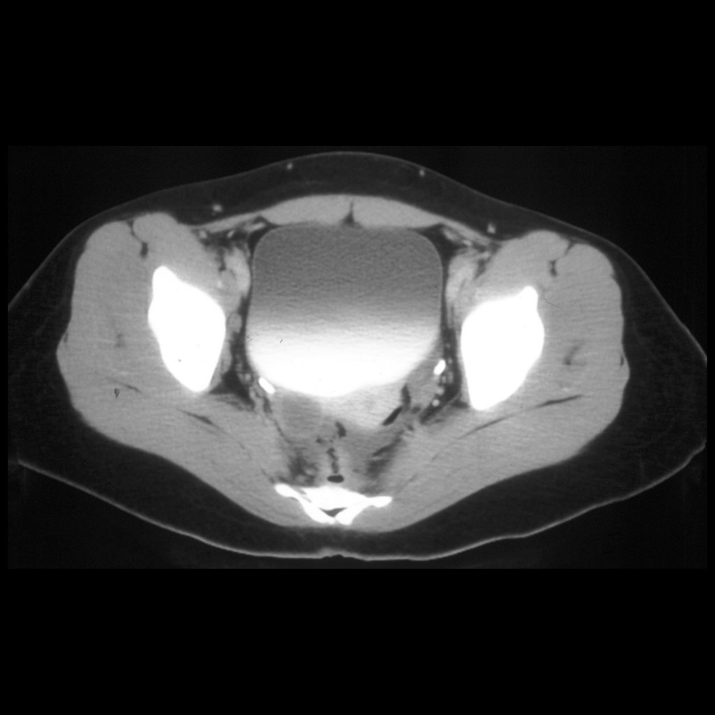 Pediatric Ovarian Cyst | Pediatric Radiology Reference Article ...