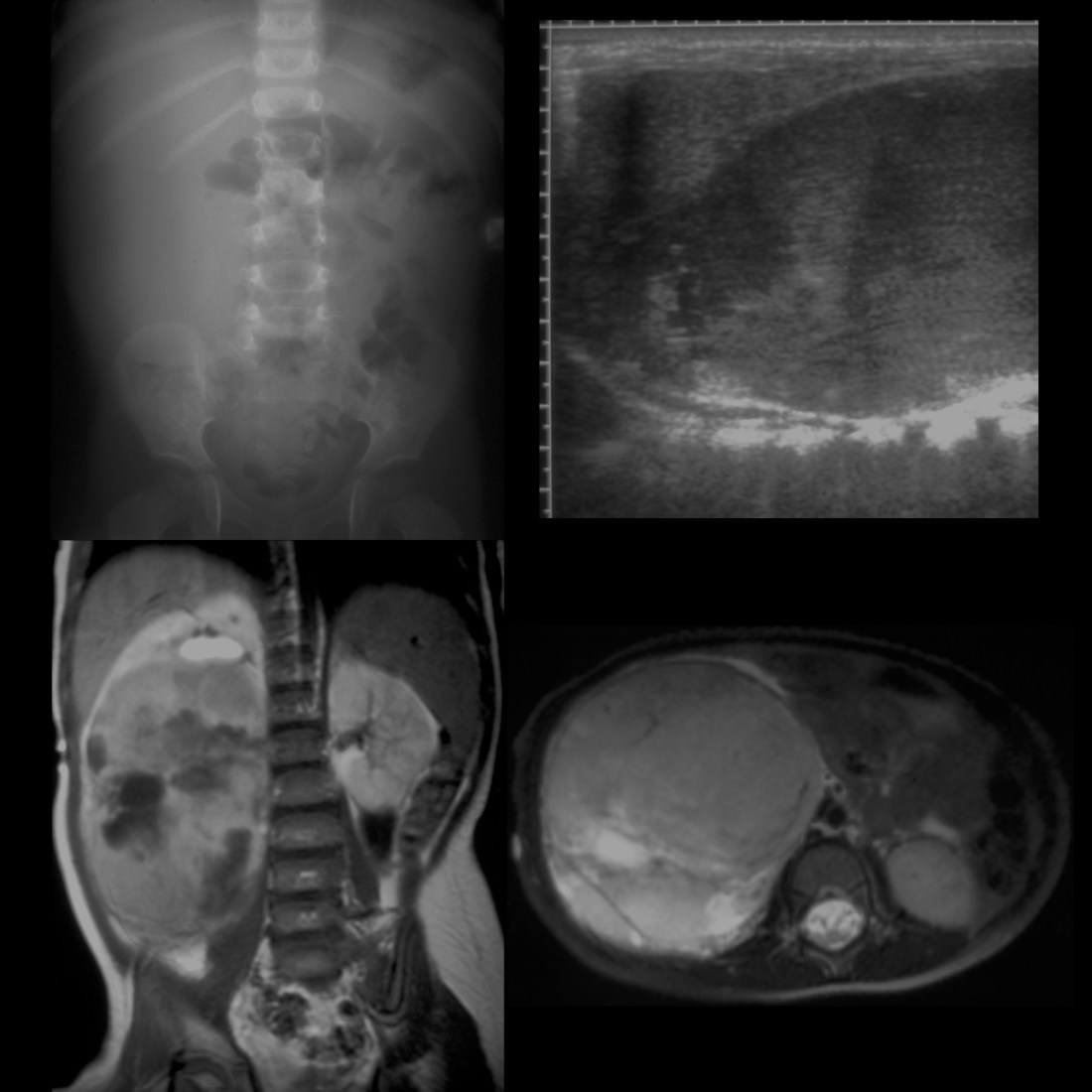 Wilms Tumor | Pediatric Radiology Reference Article | Pediatric Imaging ...