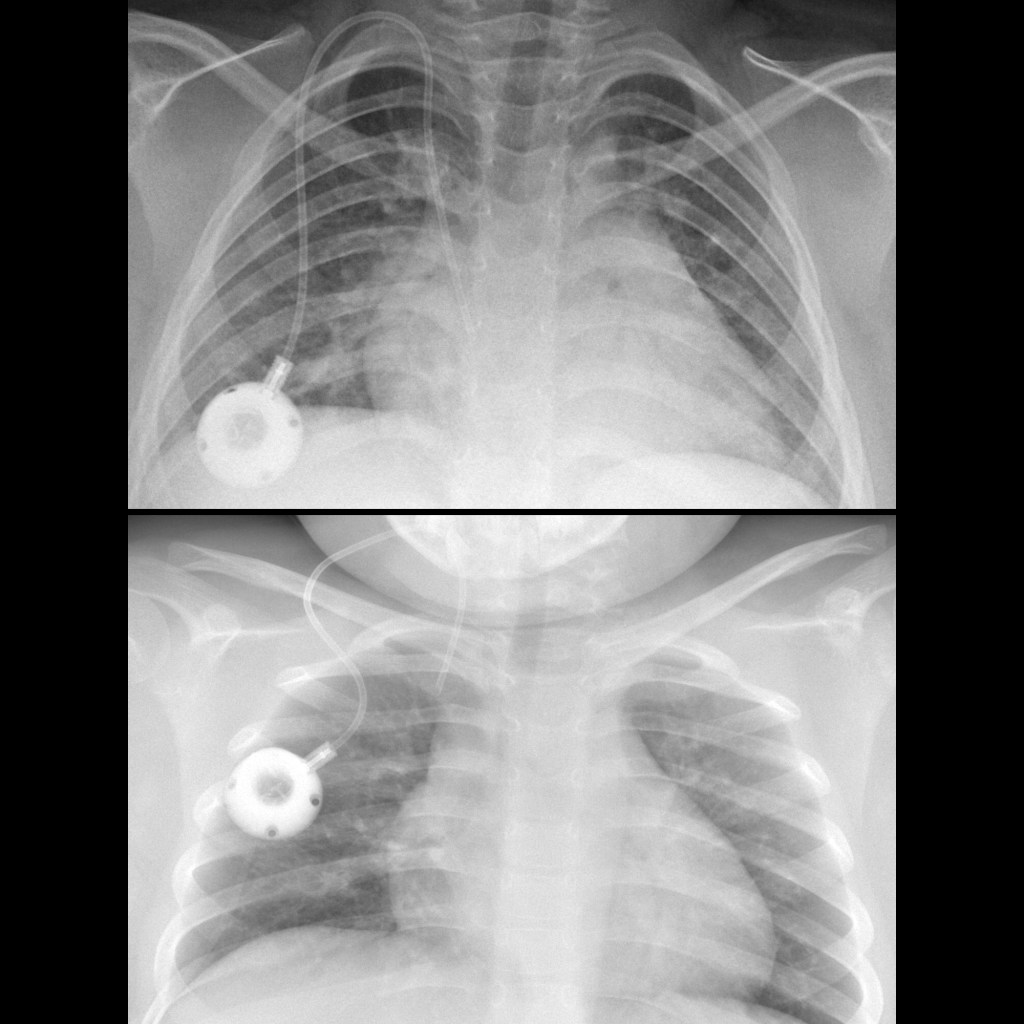 School ager with a central venous catheter that infuses but does not ...