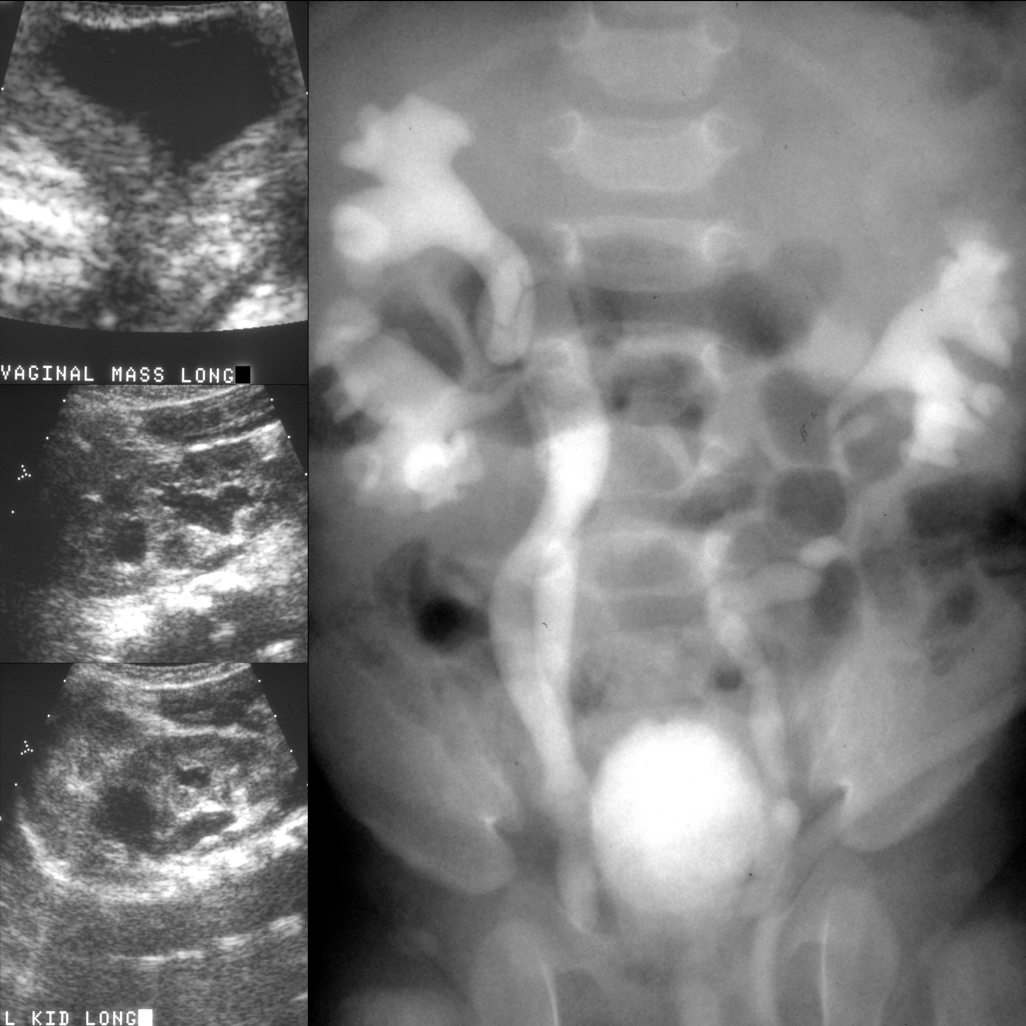 Ectopic Ureterocele | Pediatric Radiology Reference Article | Pediatric ...