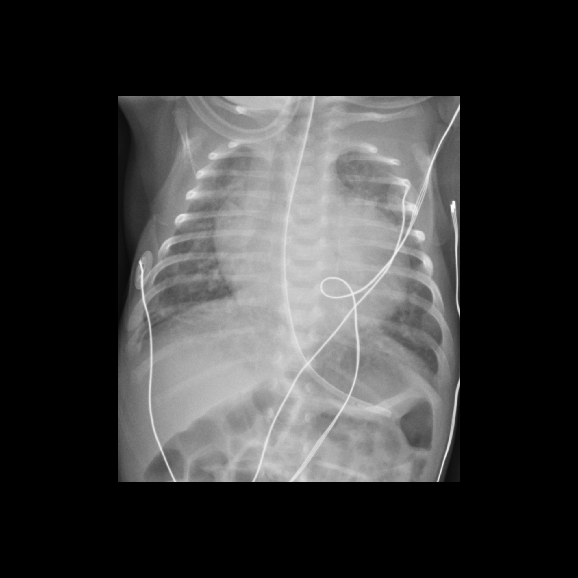 Pediatric Patent Ductus Arteriosus | Pediatric Radiology Reference ...