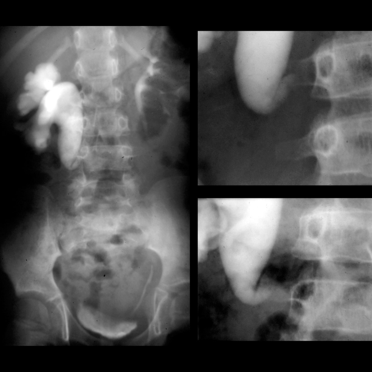 Teenager with right flank pain when drinking large amounts of soda pop ...