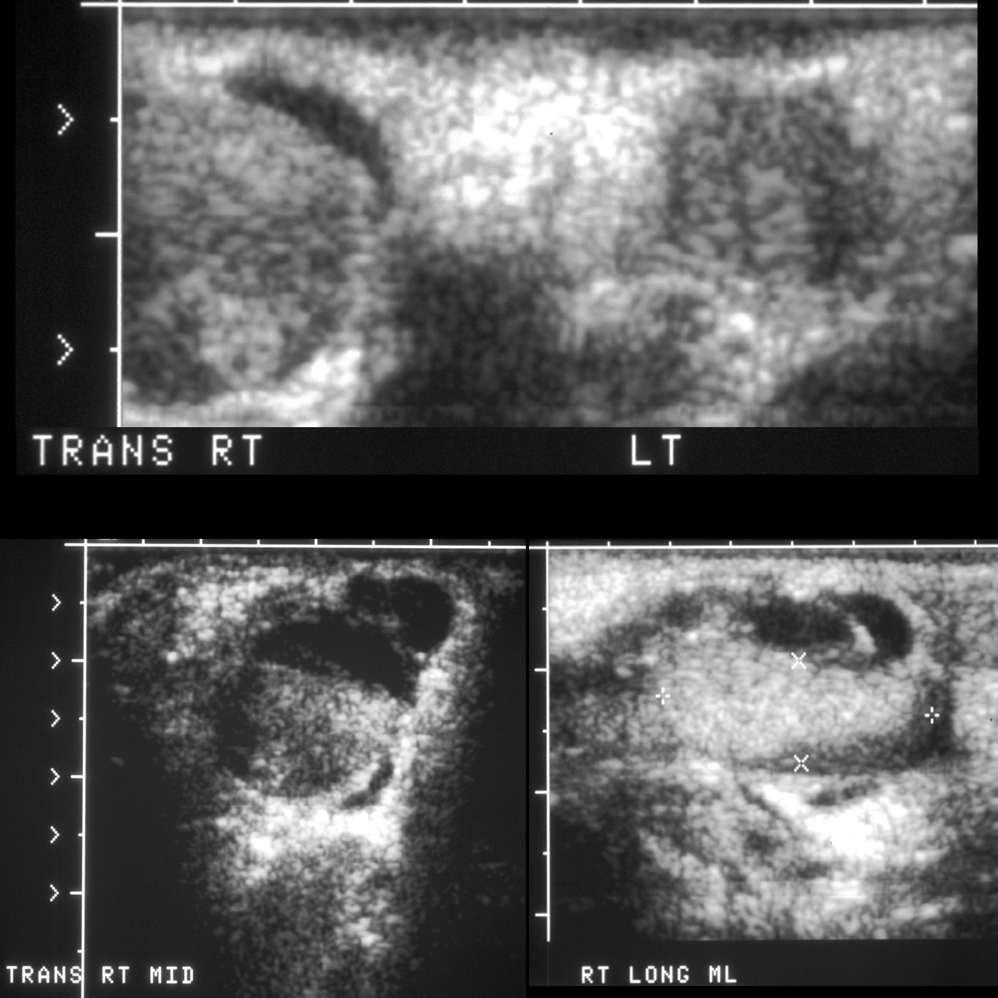 Pediatric Testicle Trauma | Pediatric Radiology Reference Article ...
