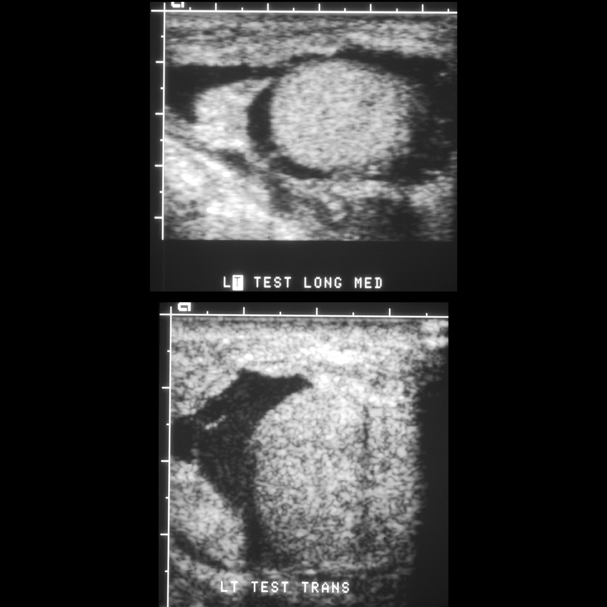 Teenager kicked in the left scrotum | Pediatric Radiology Case ...