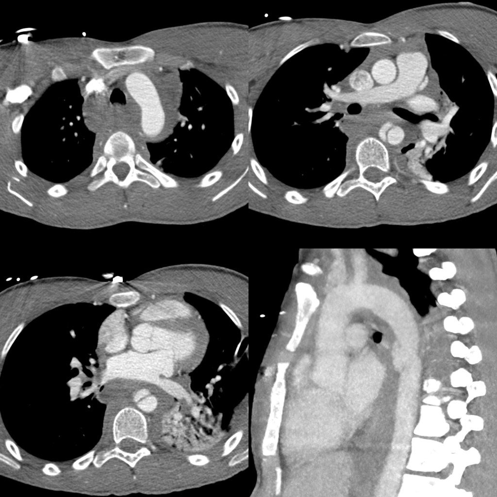Pediatric Thoracic Aortic Injury | Pediatric Radiology Reference ...