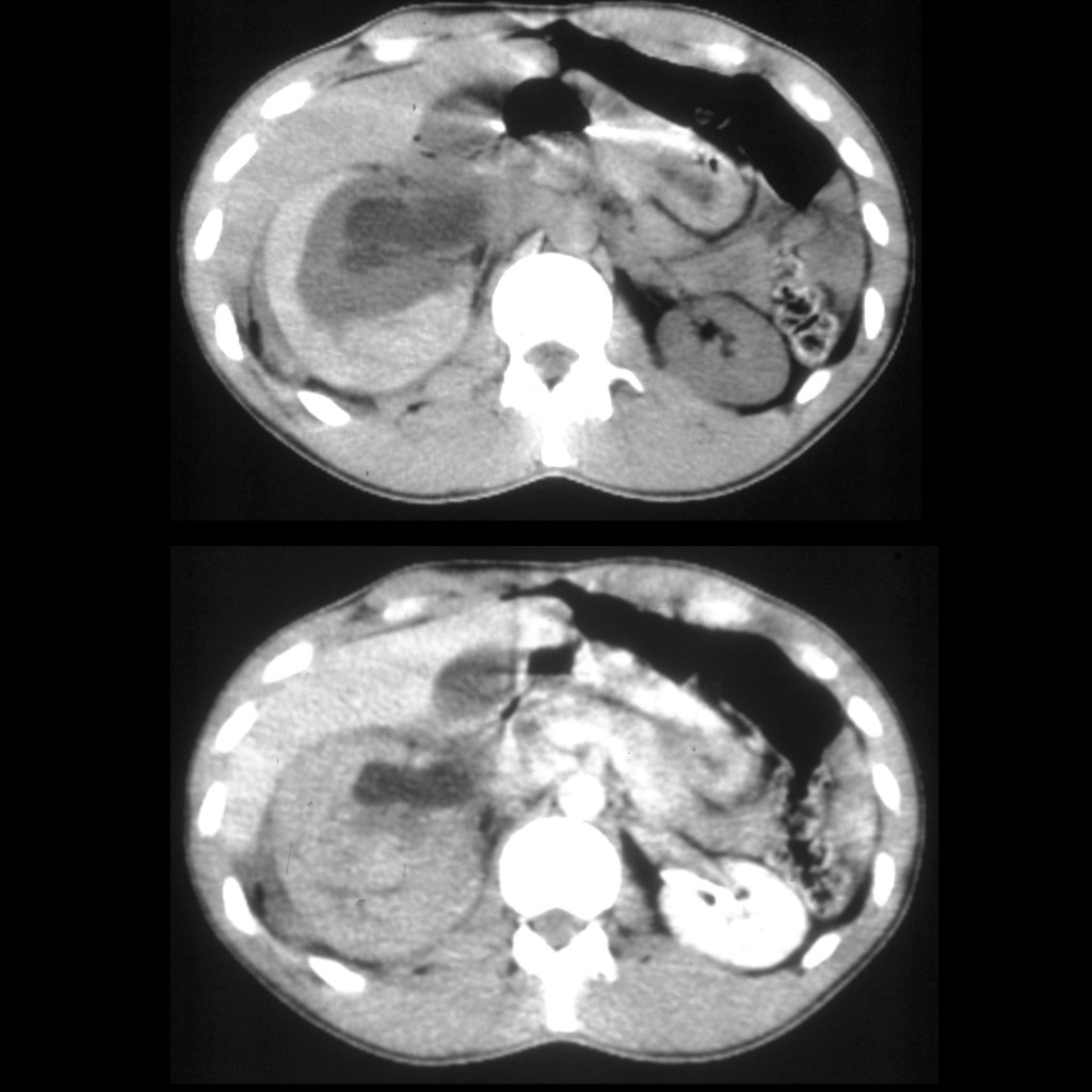 Pediatric Ureteropelvic Junction Obstruction | Pediatric Radiology ...