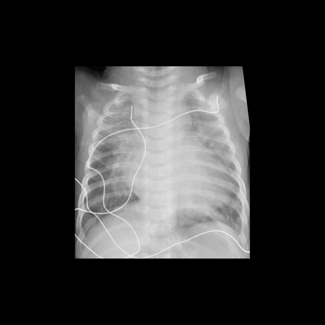 Pediatric Ventricular Septal Defect | Pediatric Radiology Reference ...