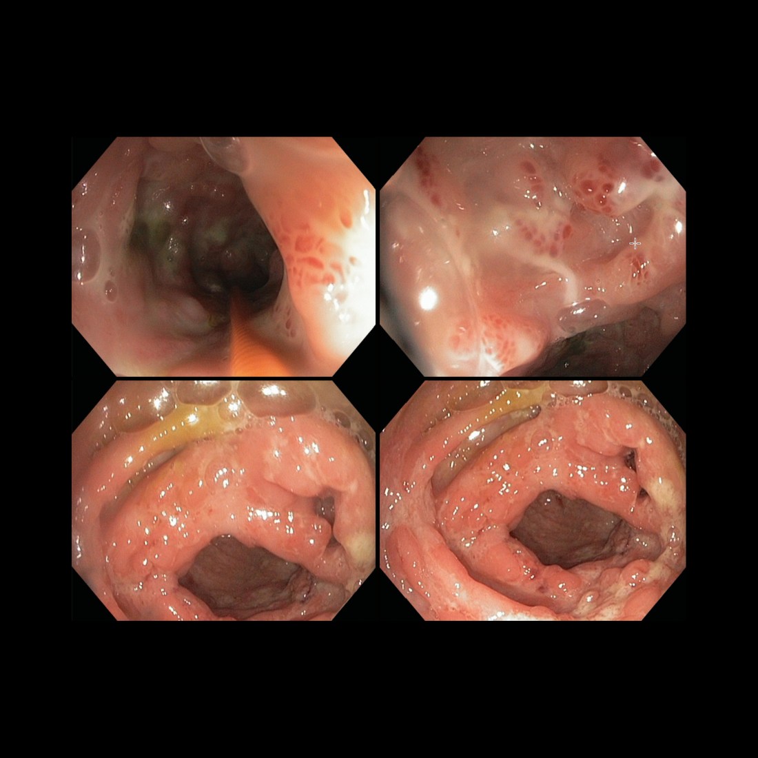 Teenager with chronic right lower quadrant pain | Pediatric Radiology ...