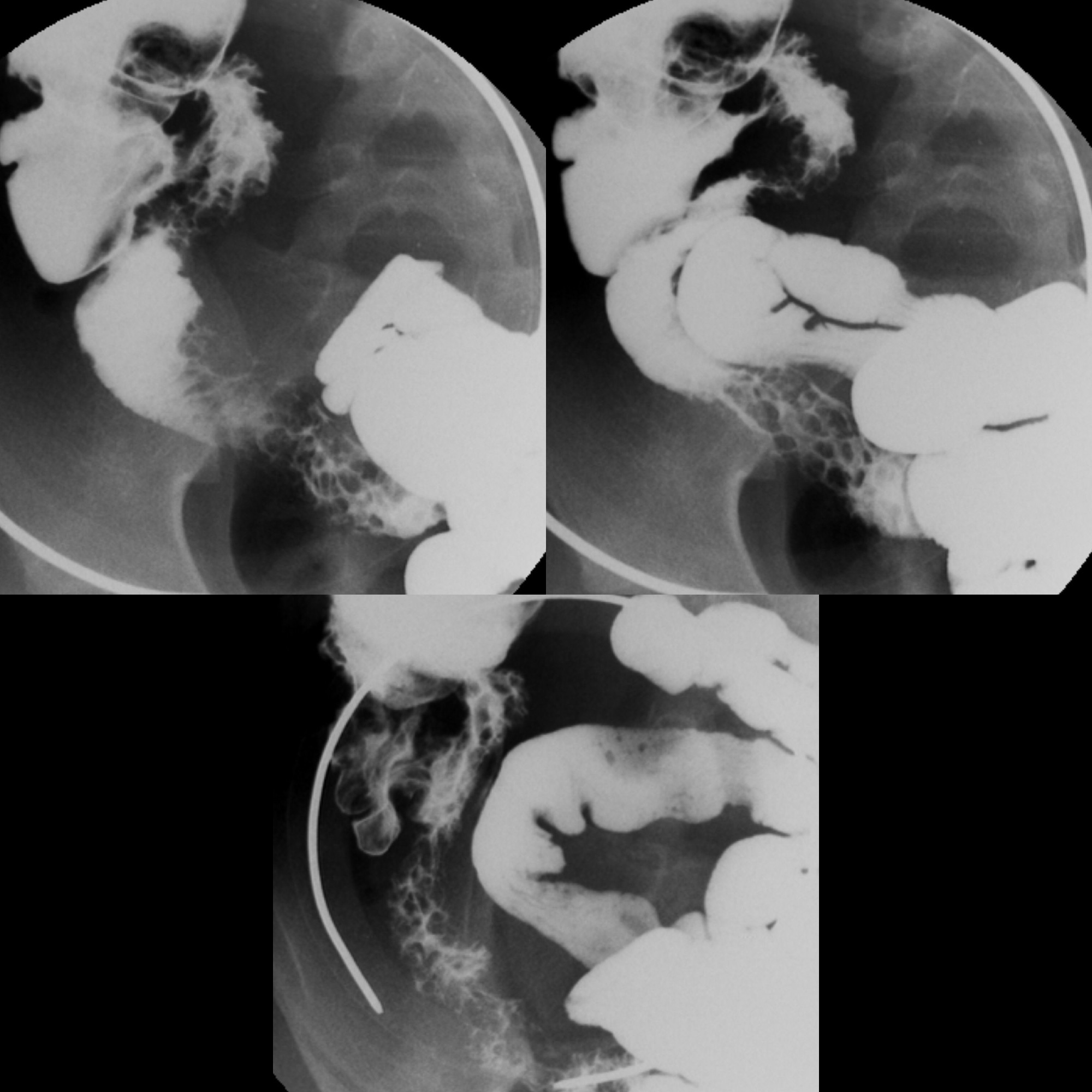 Pediatric Crohn Disease | Pediatric Radiology Reference Article ...