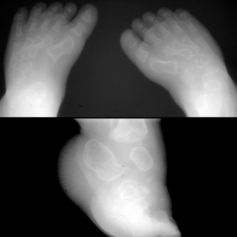 Clubfoot | Pediatric Radiology Reference Article | Pediatric Imaging ...