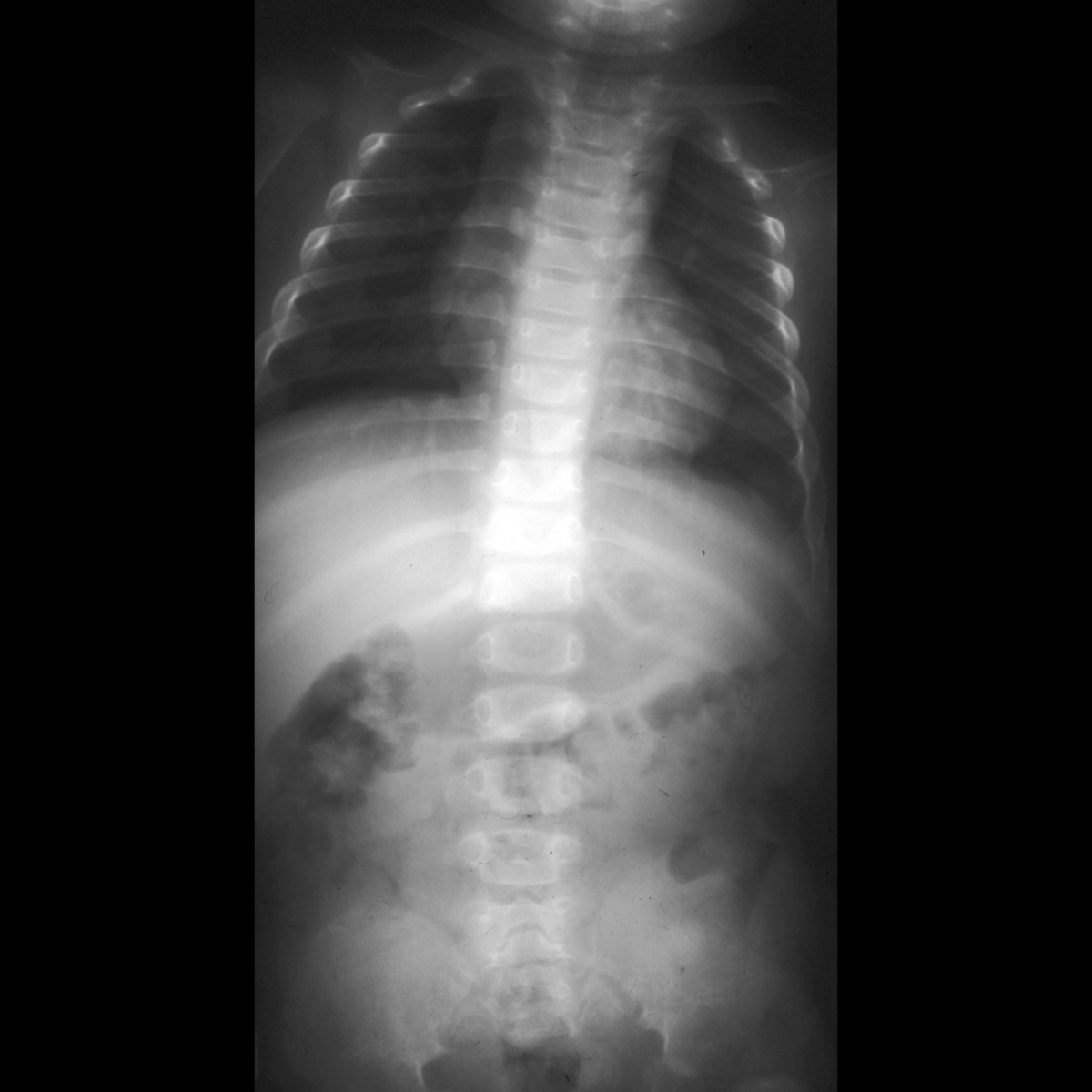 Infant with short limbs | Pediatric Radiology Case | Pediatric Imaging ...