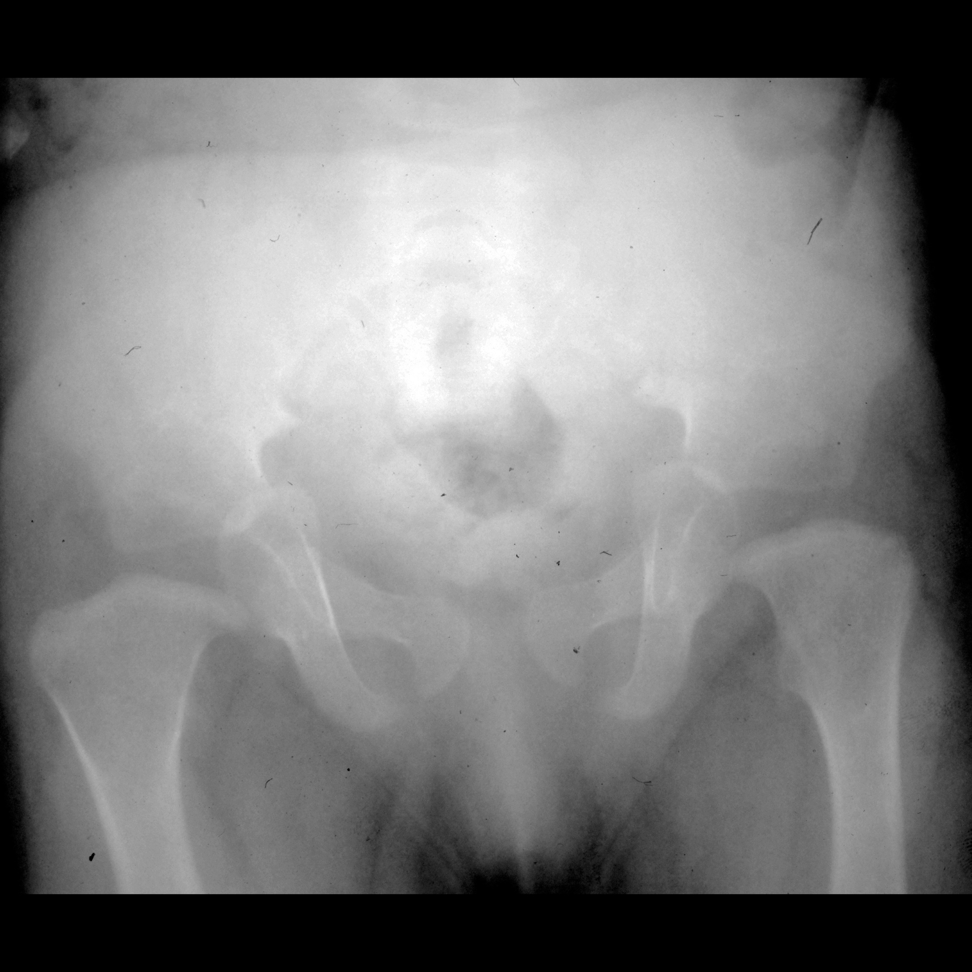 DiastrophicDwarfismTCHDwarfWideIntertrochanterNoFemoralEpiphysesPelvisP ...