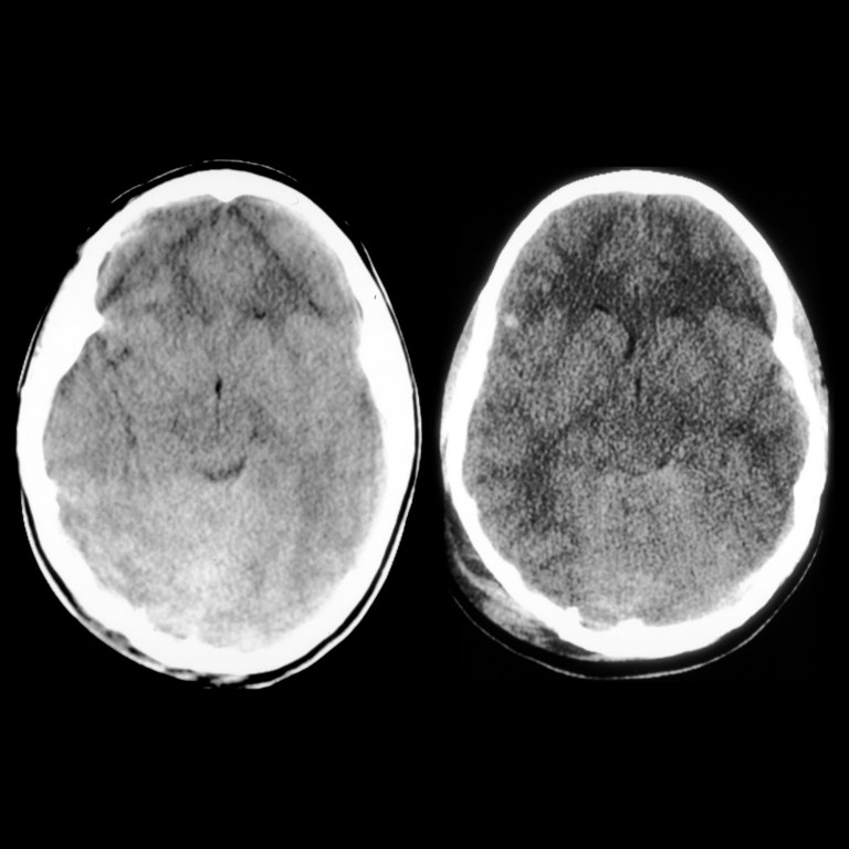 Pediatric Diffuse Cerebral Edema | Pediatric Radiology Reference ...