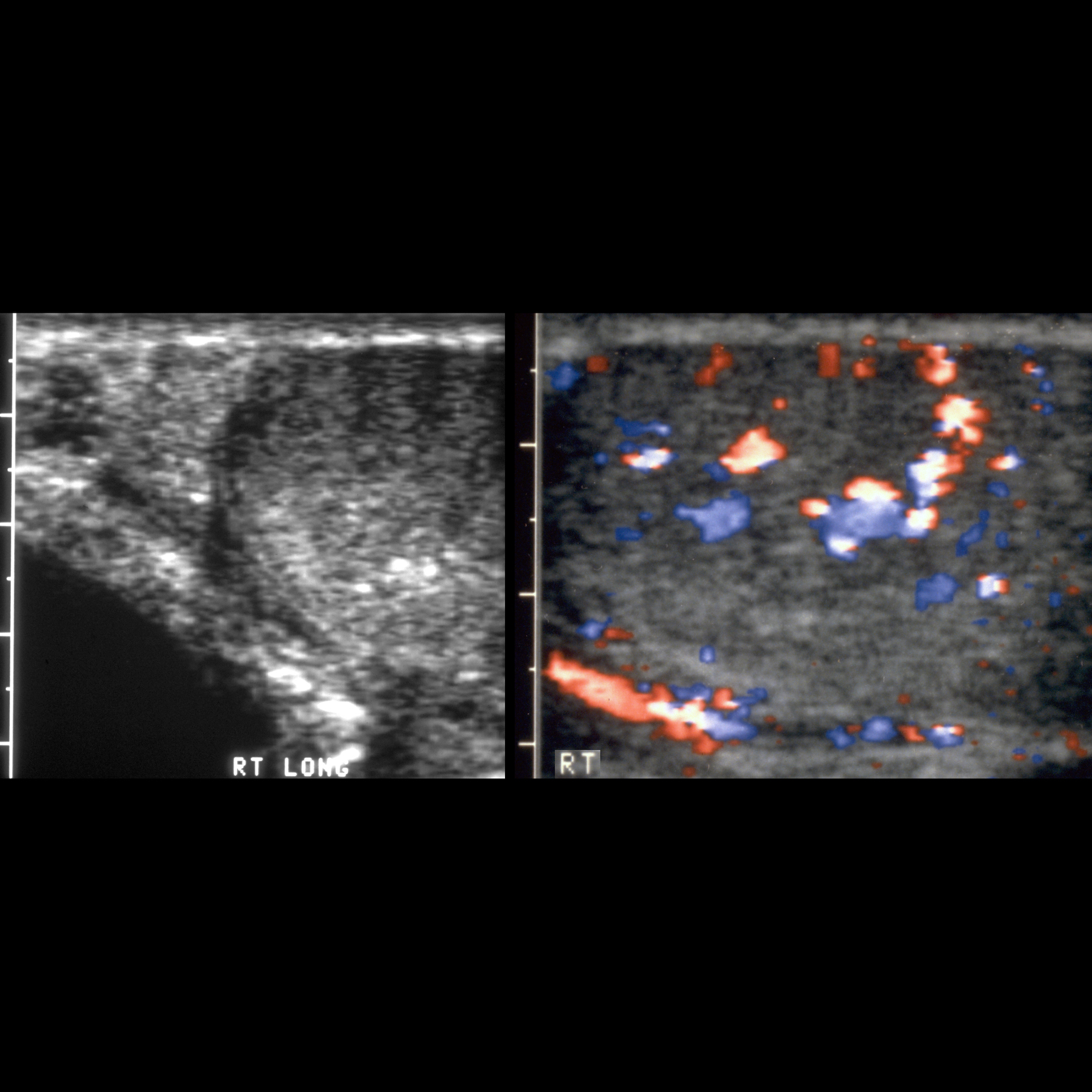 School ager with right scrotal pain | Pediatric Radiology Case ...